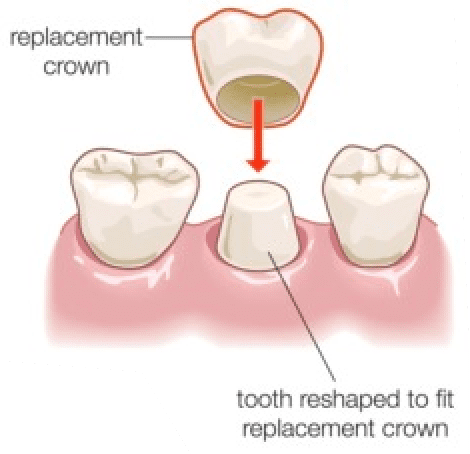 Dental Crowns / Bridges - vevaydental.ie